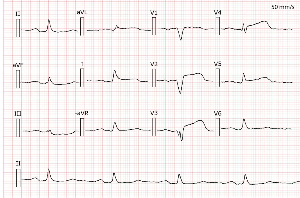 EKG-övning för studenter - Klinisk diagnostik