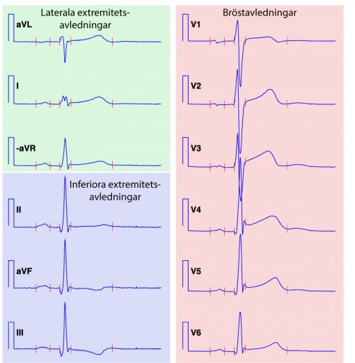 EKG-avledningar och avledningssystem - EKG.nu