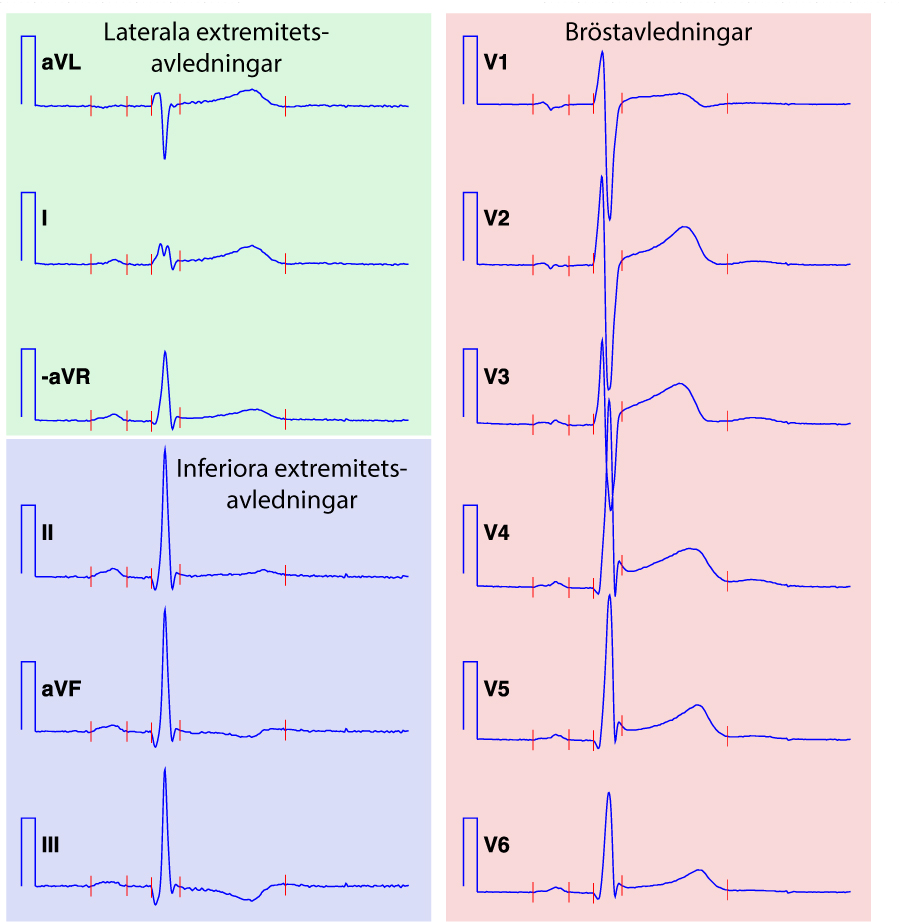 EKG-avledningar och avledningssystem - EKG.nu