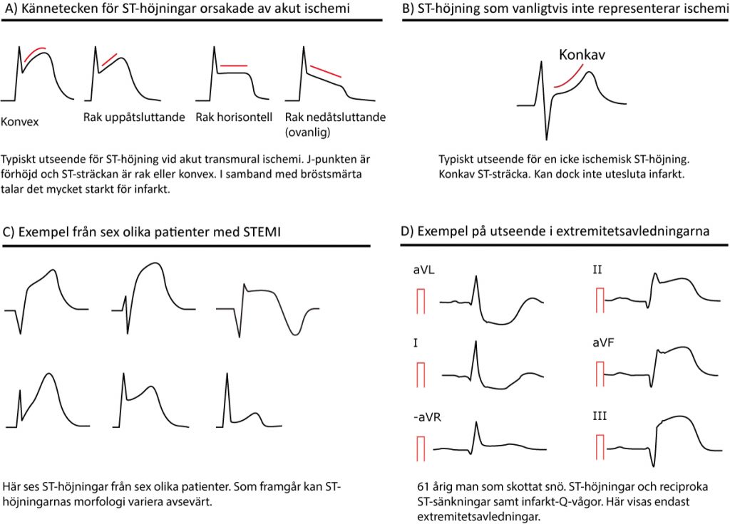 Den normala EKG-kurvan, normalvarianter och patologiska fynd - EKG.nu