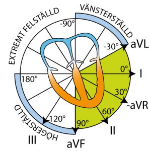 Figur 32. Extremitetsavledningarna och hjärtats el-axel. - EKG.nu