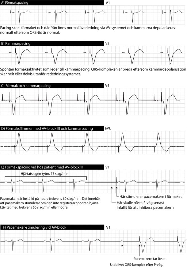 EKG-diagnostik med pacemaker, ICD & CRT - Klinisk diagnostik