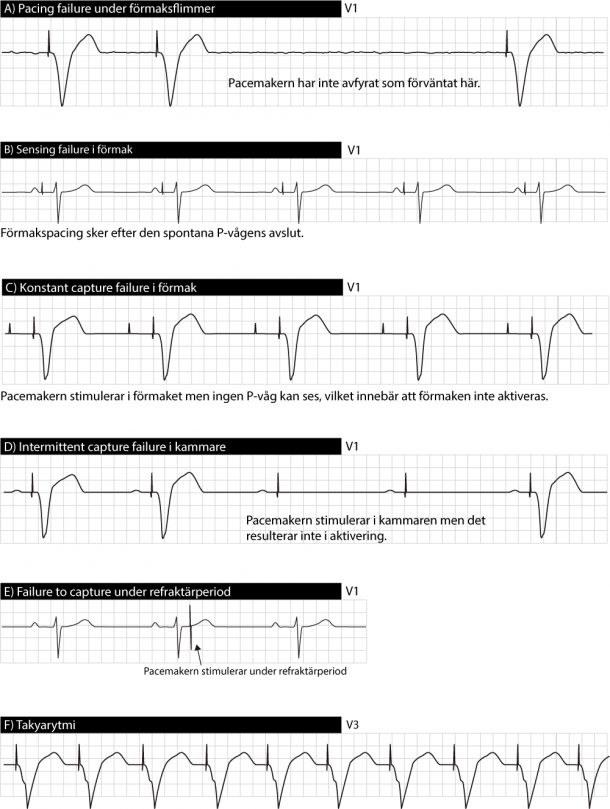 EKG-diagnostik med pacemaker, ICD & CRT - Klinisk diagnostik