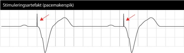 EKG-diagnostik med pacemaker, ICD & CRT - Klinisk diagnostik
