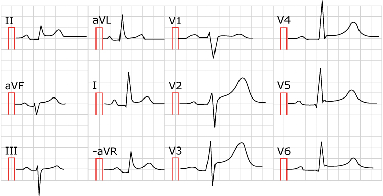 Perikardit, myokardit & perimyokardit: orsaker, EKG, behandling - EKG.nu