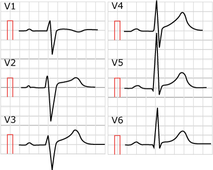 ST-höjning vid akut ischemi & differentialdiagnoser - EKG.nu