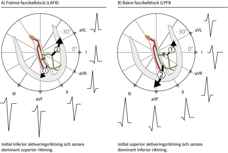 Främre fascikelblock (LAH) och bakre fascikelblock (LPH) - Klinisk ...
