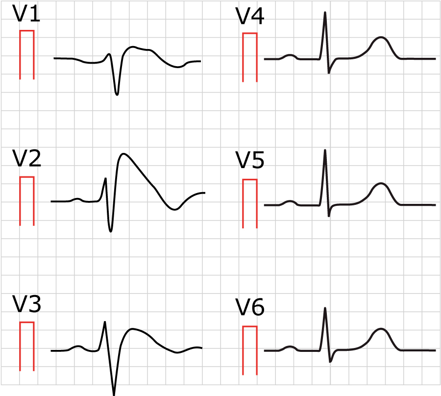 EKG-test 3 – EKG & ECHO