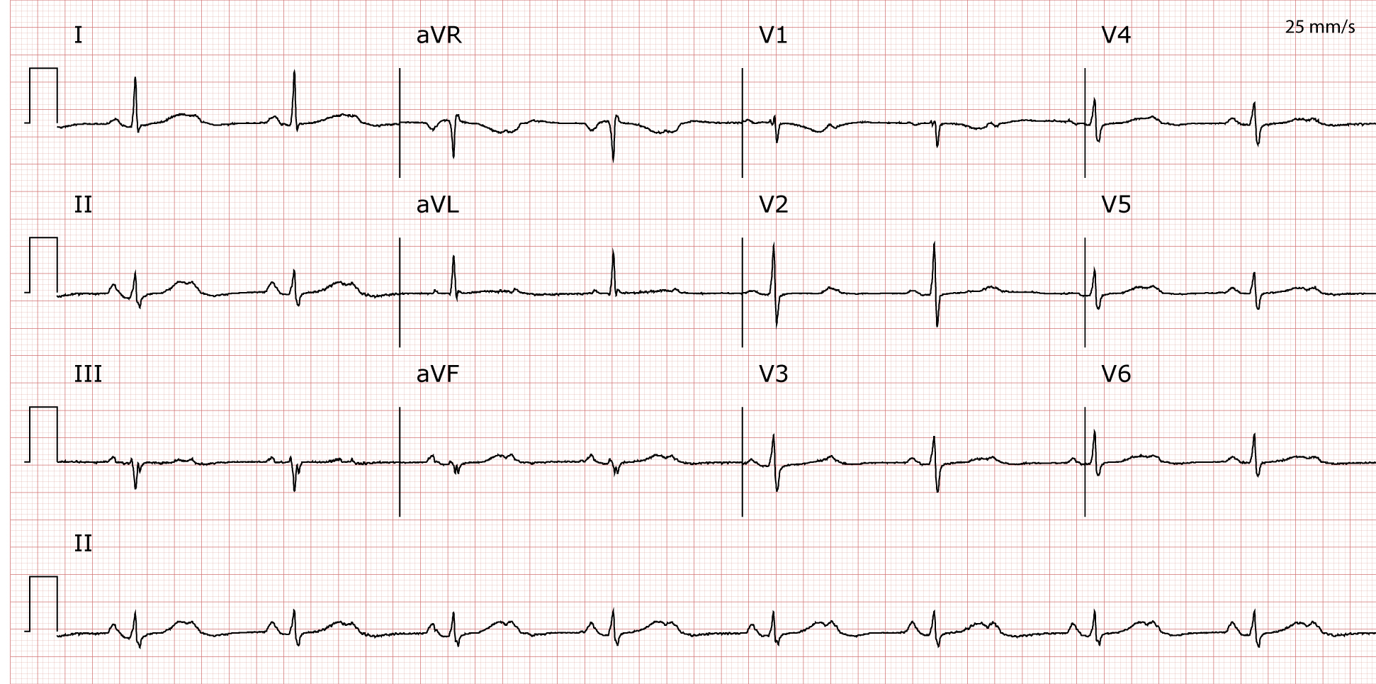 EKG-test 6 – EKG & ECHO