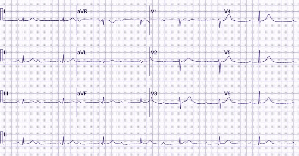 Veckans EKG-fall: AV-block 3 - Klinisk diagnostik