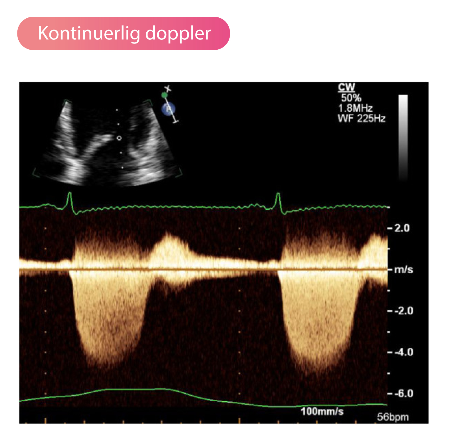 Kontinuerlig doppler - Klinisk diagnostik