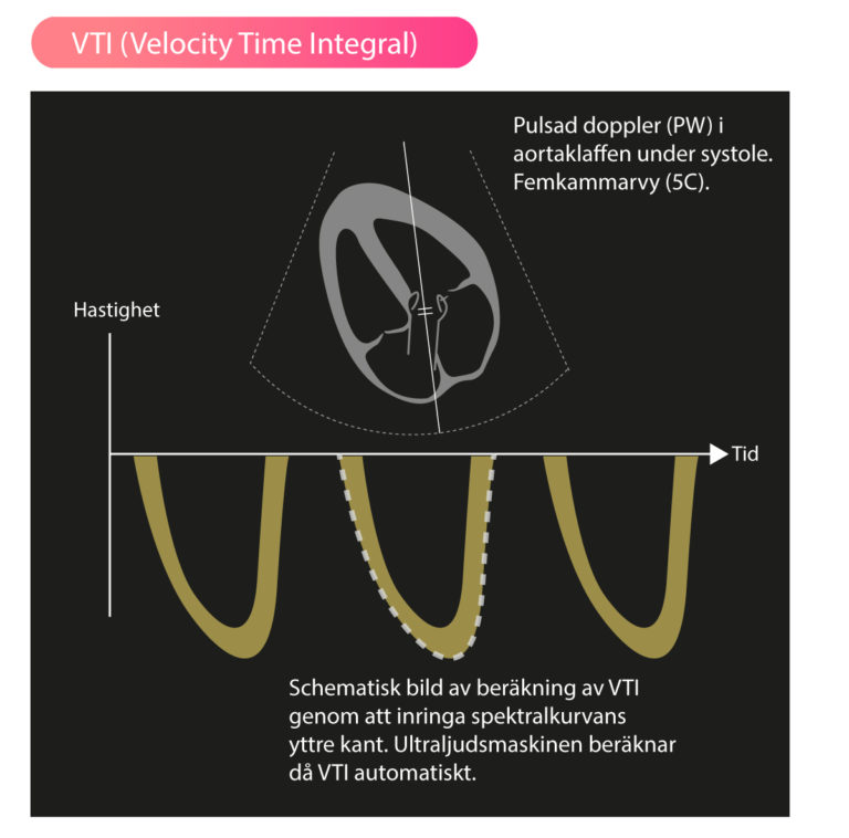 Slagvolym, VTI (Velocity Time Integral) & Cardiac Output - Klinisk ...