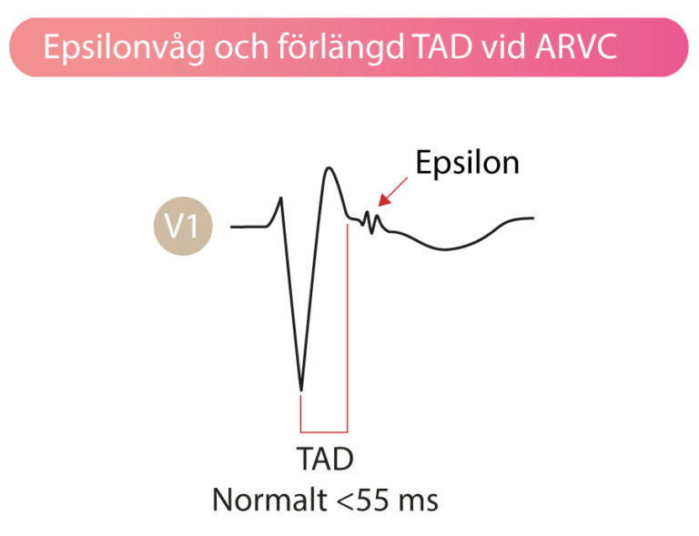 Arytmogen högerkammarkardiomyopati (Arrhythmogenic Right Ventricular ...
