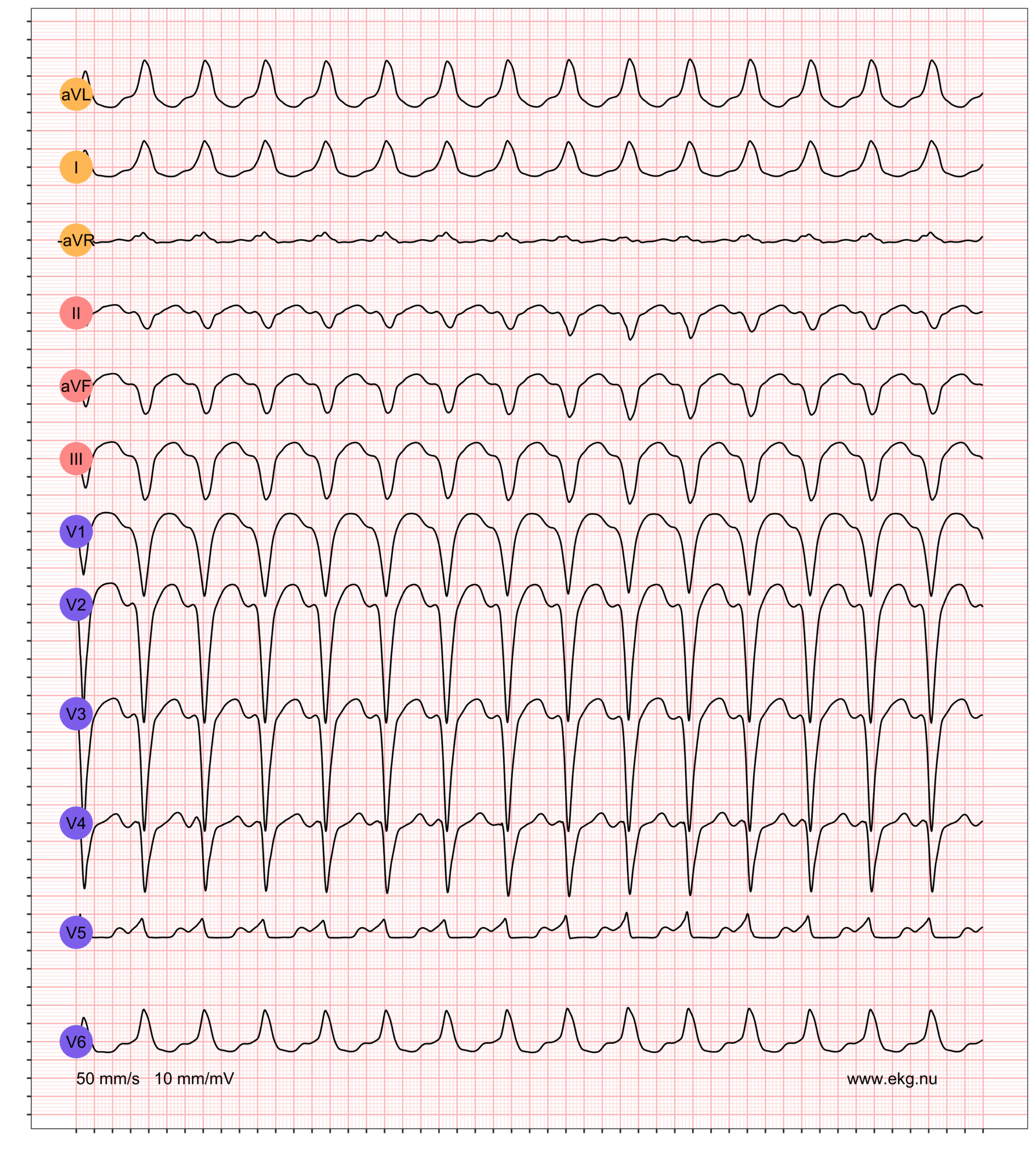 Atrioventrikulär re-entry takykardy (AVRT) & Preexcitation (WPW ...