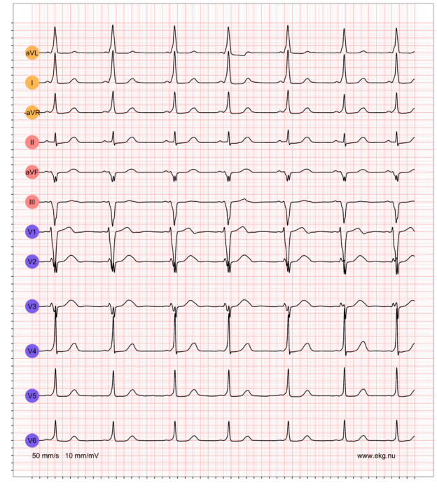 Atrioventrikulär re-entry takykardy (AVRT) & Preexcitation (WPW ...