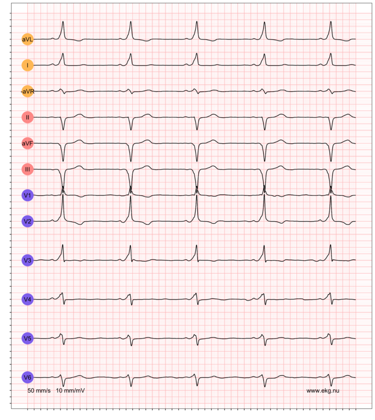 Atrioventrikulär re-entry takykardy (AVRT) & Preexcitation (WPW ...