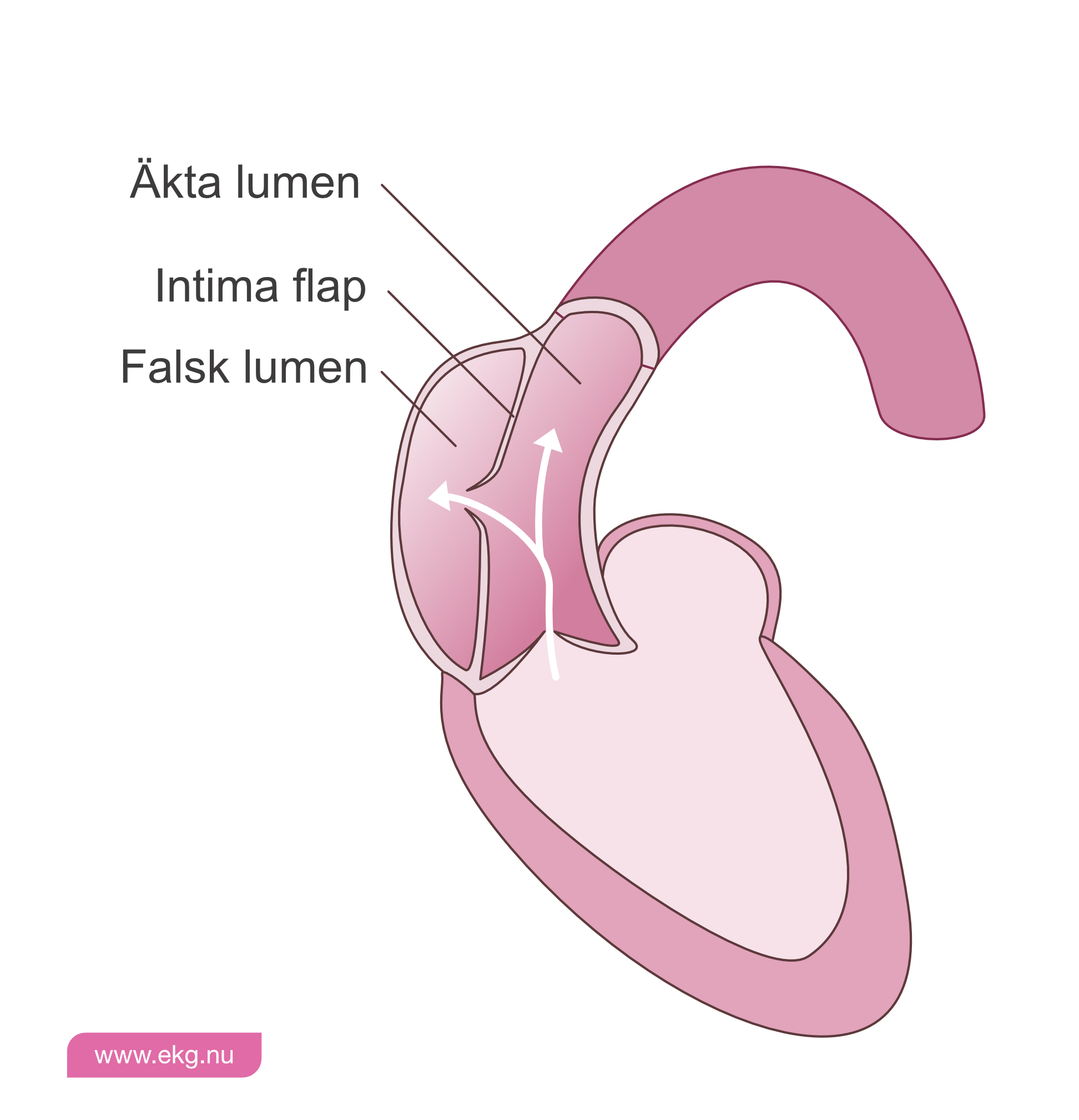 Aortadissektion And Akuta Aortasyndrom Klinisk Diagnostik