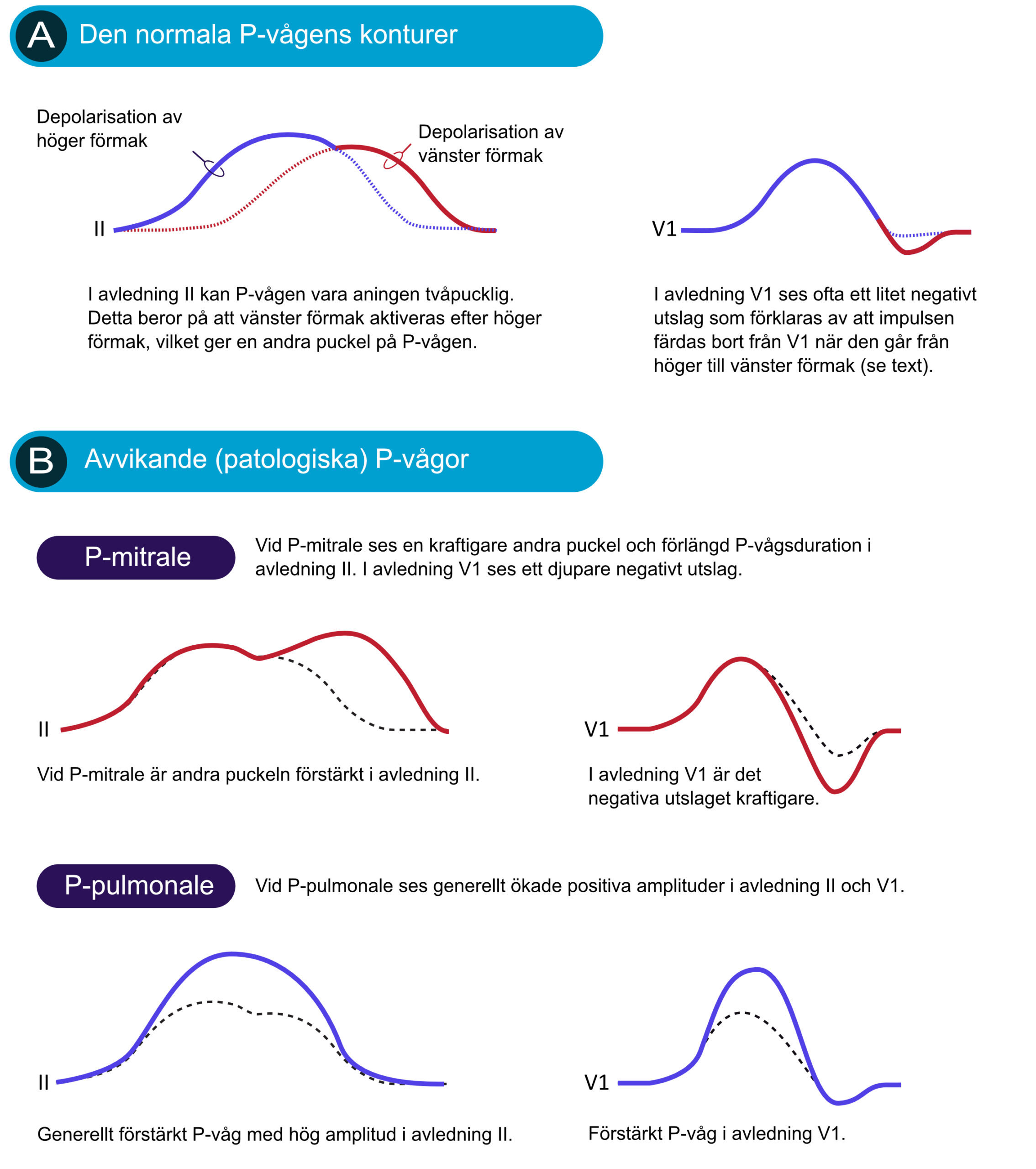 Förstorade förmak (P-pulmonale, P-mitrale) - Klinisk diagnostik