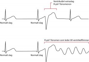 Elkonvertering och defibrillering av arytmier - Klinisk diagnostik